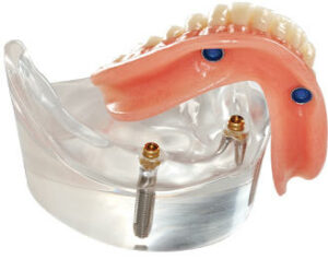 Appointment Process - Charing Cross Implant Denture Clinic