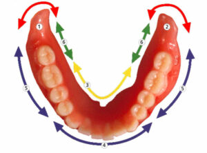 Lower Suction Dentures - Charing Cross Implant Denture Clinic